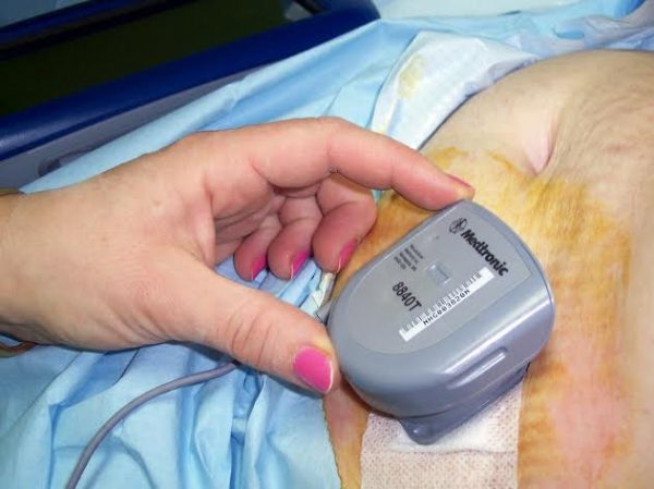 Recarga de la bomba de baclofeno intratecal - Convives con Espasticidad